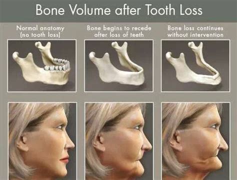What Is The Difference Between Dental Implants And Bridges