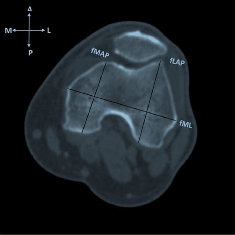 Axial Ct Image Of The Proximal Tibia Showing Mediolateral Length Tml Download Scientific