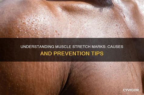 Understanding Muscle Stretch Marks Causes And Prevention Tips Cyvigor
