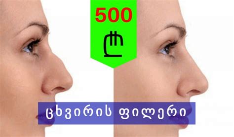 ცხვირის ფილერები