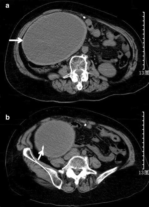 A Abdominal Ct Demonstrated A Large Cyst Comprising A Collection Of