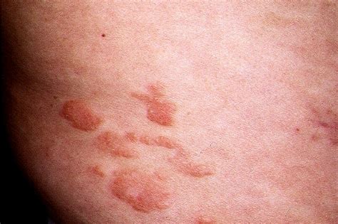 La Micosis Cutánea Una Infección Que Está En El Aire Remedios Caseros