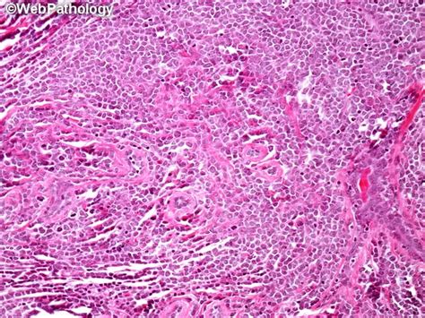 Myeloid Sarcoma Breast