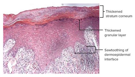 Erosive Lichen Planus Histology