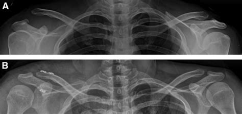 Arthroscopic Assisted Coracoclavicular Ligament Reconstruction For Acute Acromioclavicular