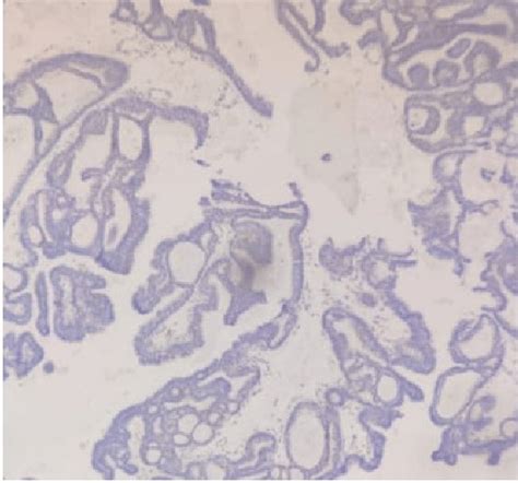 Tumor Cells Negative For Cd117 Ihc×4 Download Scientific Diagram