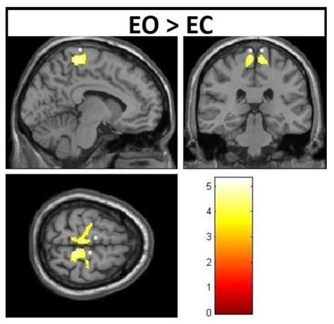 Voxel Based Morphometry Vbm Observed Gray Matter Gm Download Scientific Diagram