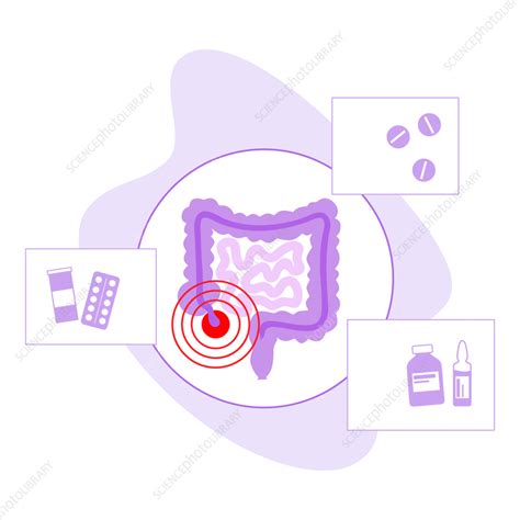 Inflamed Appendix Conceptual Illustration Stock Image F035 7120 Science Photo Library
