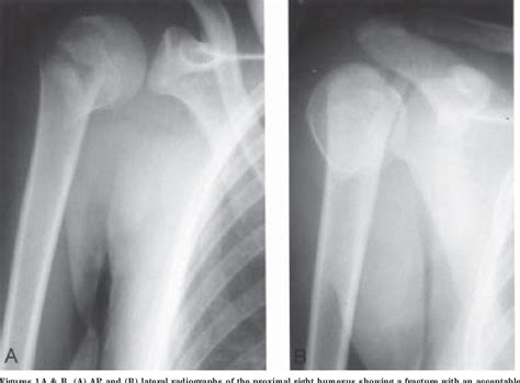 Figure 1 From Transitory Inferior Dislocation Of The Shoulder In A