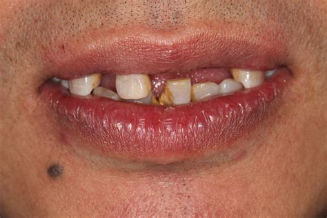 Upper And Lower All On Four Permanent Ceramic Fixed Bridges Using Transitional Immediate