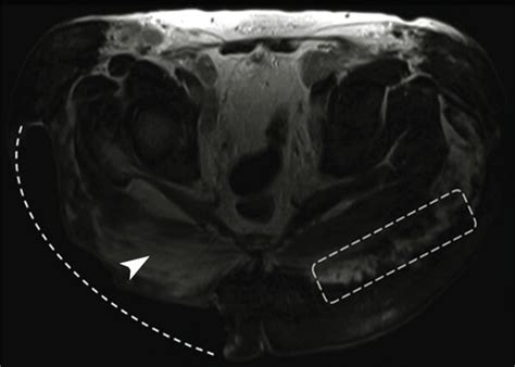 Magnetic Resonance Imaging Stir Sequence Applied In Two Different Download Scientific Diagram