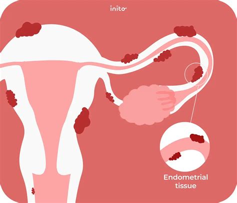 Getting Pregnant With Endometriosis Success Stories