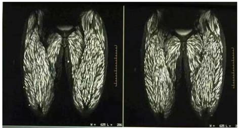 생고기 즐기던 여성 뇌를 포함해 전신에 기생충 감염 세계일보