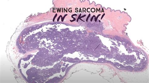 Ewing Sarcoma Arising In Skin Australasian Dermpath 2022 Case 6