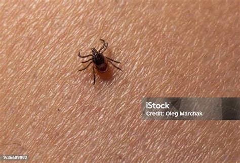 털이 많은 인간의 피부에 감염된 여성 사슴 진드기 Ixodes Ricinus 기생 진드기 아카루스 표피 세부 사항의 배경에 위험한 물기 곤충 감염의 역겨운 매개체 진드기
