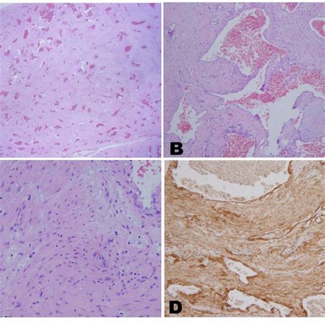 Light Micrograph Of Excisional Biopsy Specimen A Photomicrographs Download Scientific