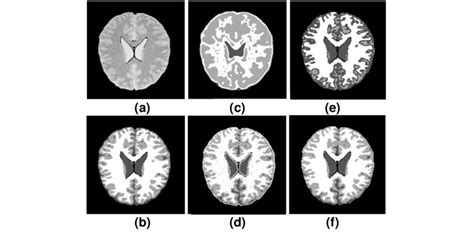 Comparison Of Segmentation Results On Simulated Pd Weighted Mr Brain