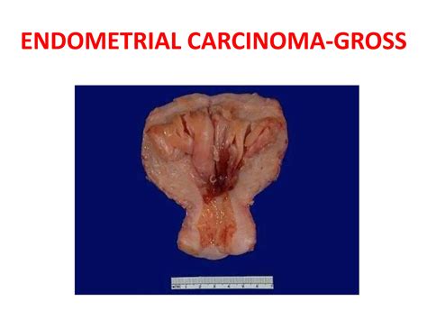 Work Up A Case Of Endometrial Cancer Ppt Menopause Endocrine And