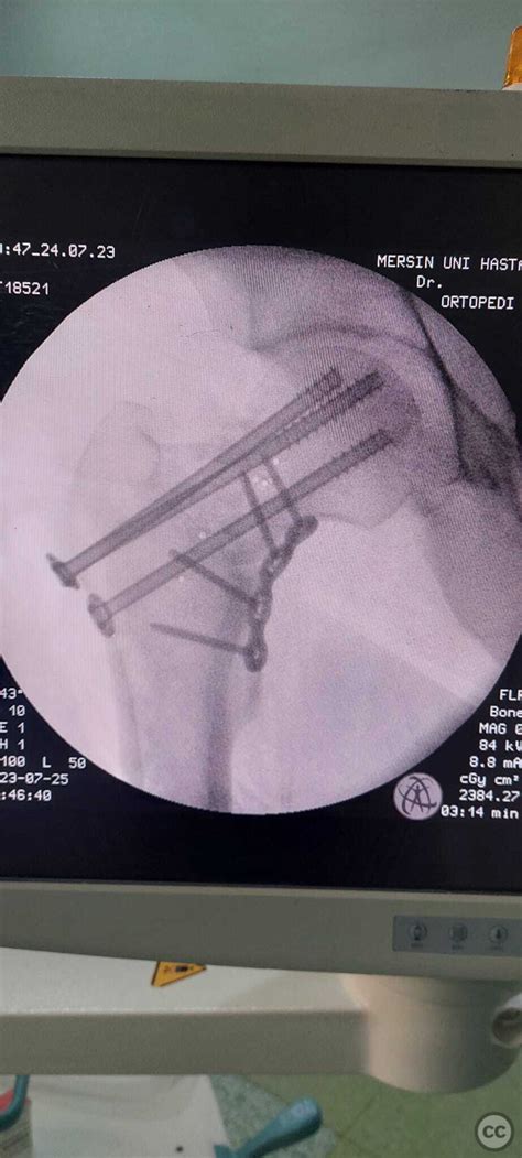 Comminuted Femur Neck Fracture
