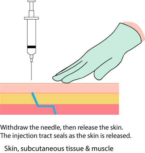 74 Intramuscular Injections Clinical Procedures For Safer Patient Care
