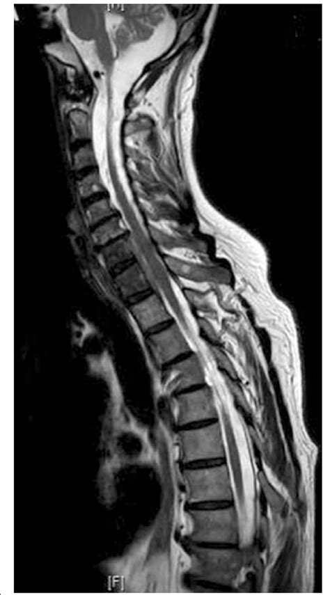 Sagittal Posttreatment Mr Image Of The Cervico Thoracic Spine 1 Day Download Scientific