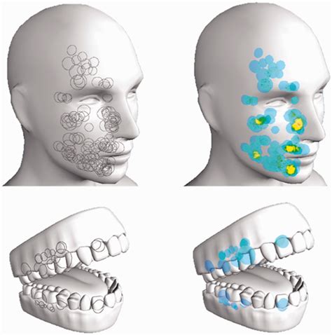Trigeminal Neuralgia Trigger Points