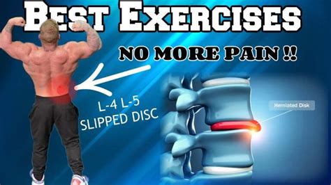 L4 L5 S1 Disc Bulge Treatment Without Surgery Exercises To Avoid