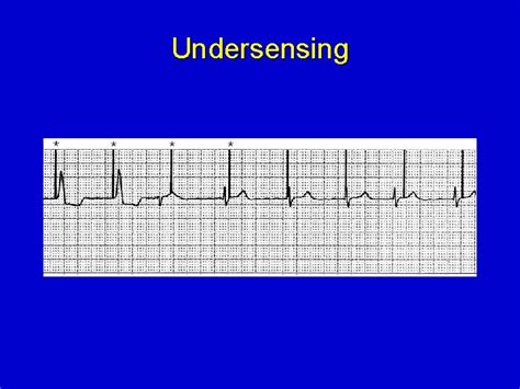 Chapter 13 Objectives Objectives Temporary Pacemakers Indications Pacemaker
