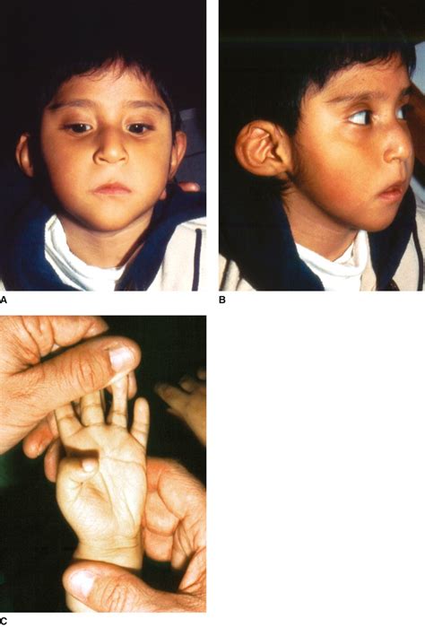 Deletion Duplication And Microduplication Syndromes Identifiable