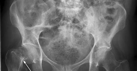 Hairline Fracture Hip Symptoms