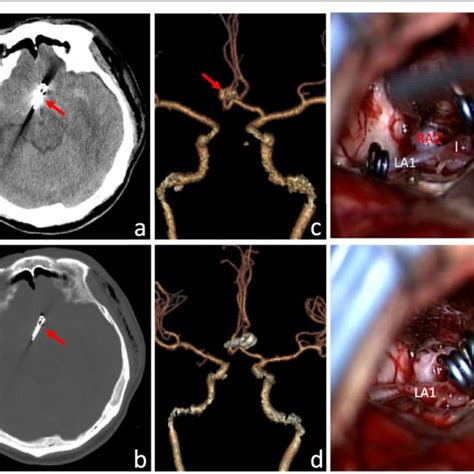 Preoperative And Postoperative Imaging Examination And Intraoperative Download Scientific