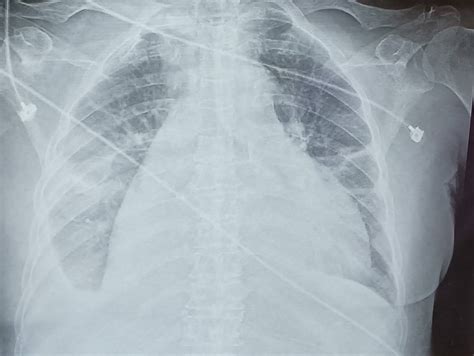 （有影片）／68歲女性罹患全身性紅斑性狼瘡 腎功能急速惡化警訊 蕃新聞