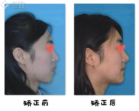 8个医生案例 牙齿矫正，拯救你的 没下巴”！ 贝致——专业口腔服务平台，让你变美的牙套交流社区
