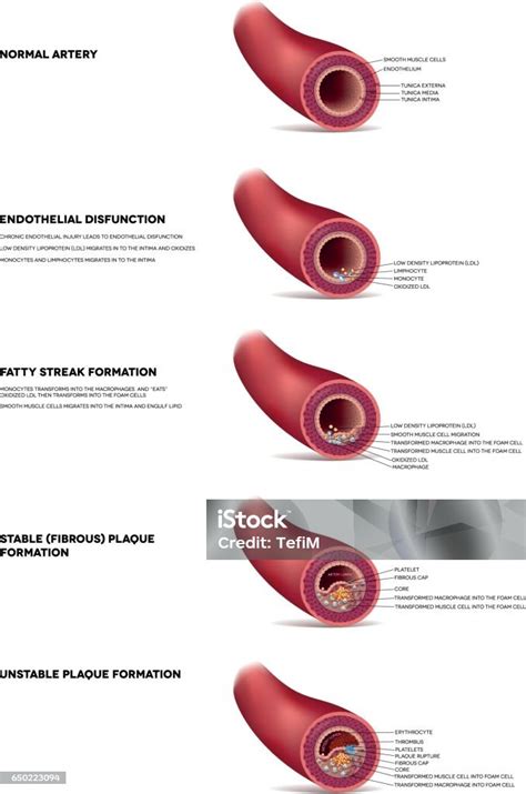 Ilustrasi Rinci Aterosklerosis Perkembangan Hingga Thrombus Ilustrasi Stok Unduh Gambar