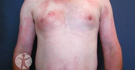 Patch Stage Mycosis Fungoides Image
