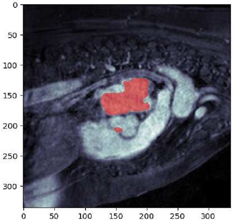 Figure 4 From Left Atrium Segmentation Using Deep Learning Model Semantic Scholar