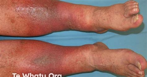 Acute Lipodermatosclerosis Image