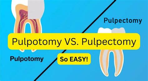 Cost Of Pulpectomy In India At Kaitlyn Maund Blog