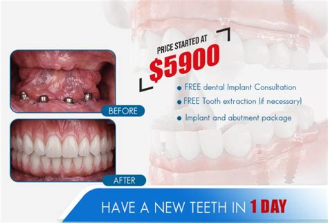 Full Mouth Dental Implant Prices List In Ho Chi Minh City Saigon