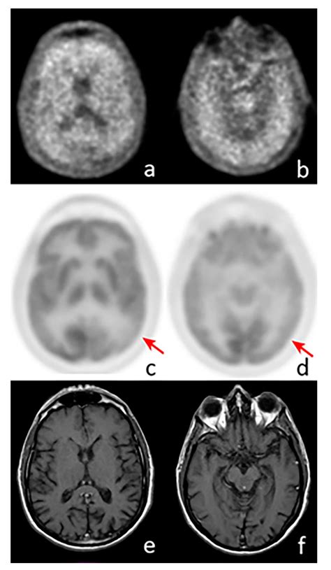 Positron Emission Tomography Brain