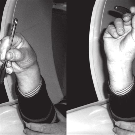 The Two End Positions Of The Dart Throwing Motion Of A Normal Wrist Download Scientific