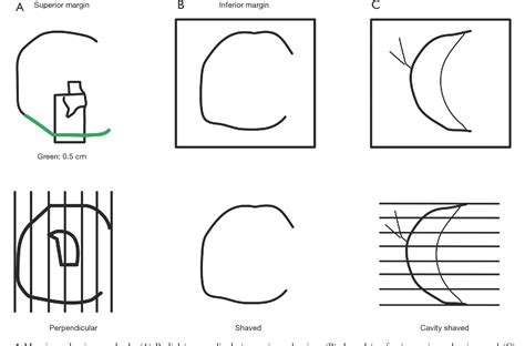 Figure 1 From Appropriate Margin For Lumpectomy Excision Of Invasive Breast Cancer Semantic