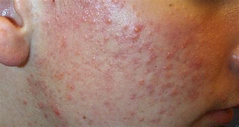 Красные точки на лице фото причины появления и как убрать