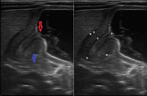 Pyloric Stenosis Ultrasound
