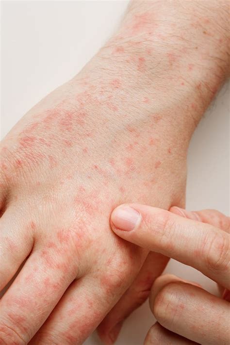 Manos Con Reacción Alérgica Por Tomar Medicamentos Dermatología Por