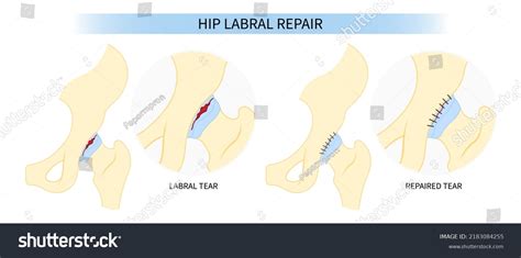 Hip Labrum Tear Over 32 Royalty Free Licensable Stock Vectors And Vector Art Shutterstock