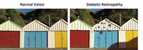Diabetic Retinopathy Symptoms Causes And Treatments Auckland Eye