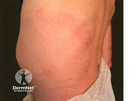 Erythema Migrans Images