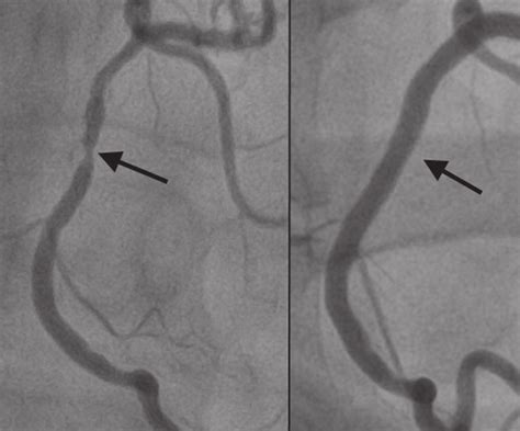Bakteriler Teknoloji Işık Adlı Pci Angiogram Uzaklaştırıcı Macera E