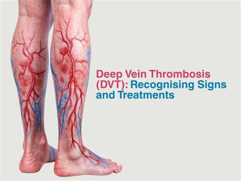 Deep Vein Thrombosis Dvt Recognising Signs And Treatments
